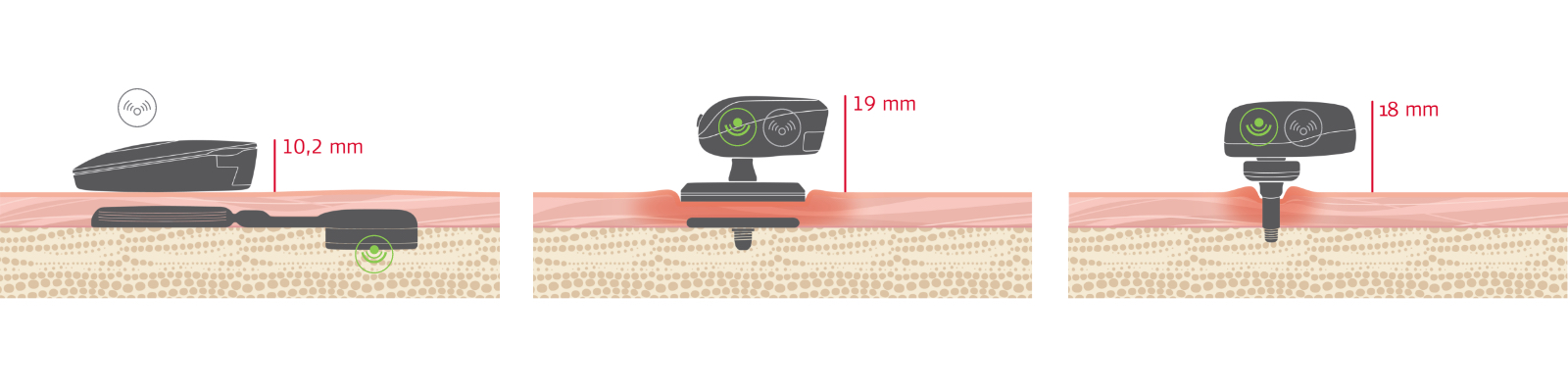 How Reliable Is BONEBRIDGE? An Update on Its Track Record - MED-EL ...